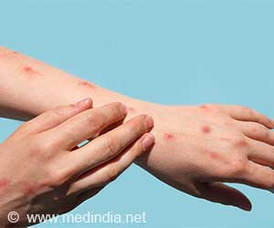 Two US scientists accused of smuggling deactivated MPOX virus vials