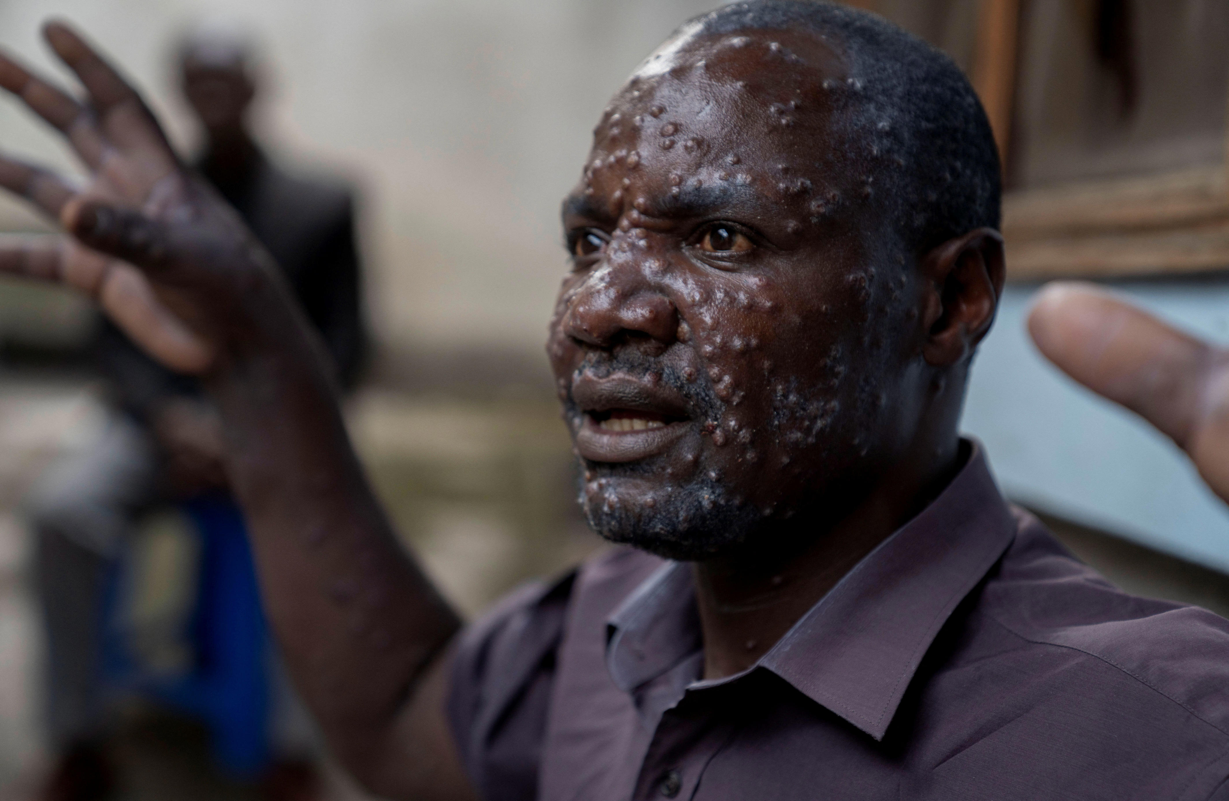 Scientists charged with smuggling deactivated mpox virus into US