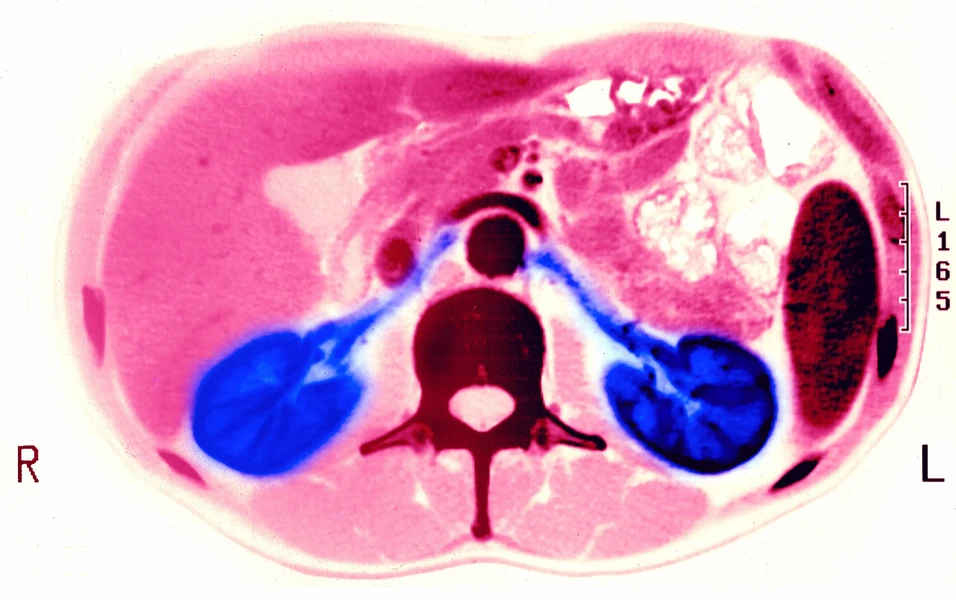 Lancet projects chronic kidney disease to be 5th top killer by 2040