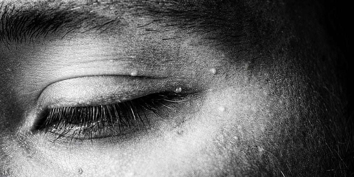 This common skin condition looks like acne—but isn’t. Here's how to ...