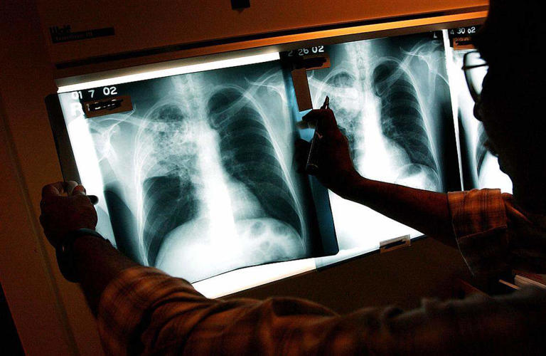 What new science says about building bone density after 50, including ...