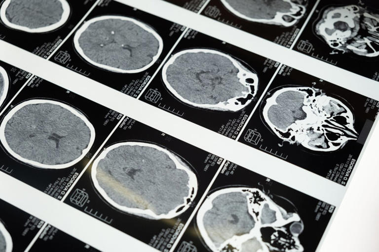 Brain tumor removal may improve blood sugar control in diabetes patients