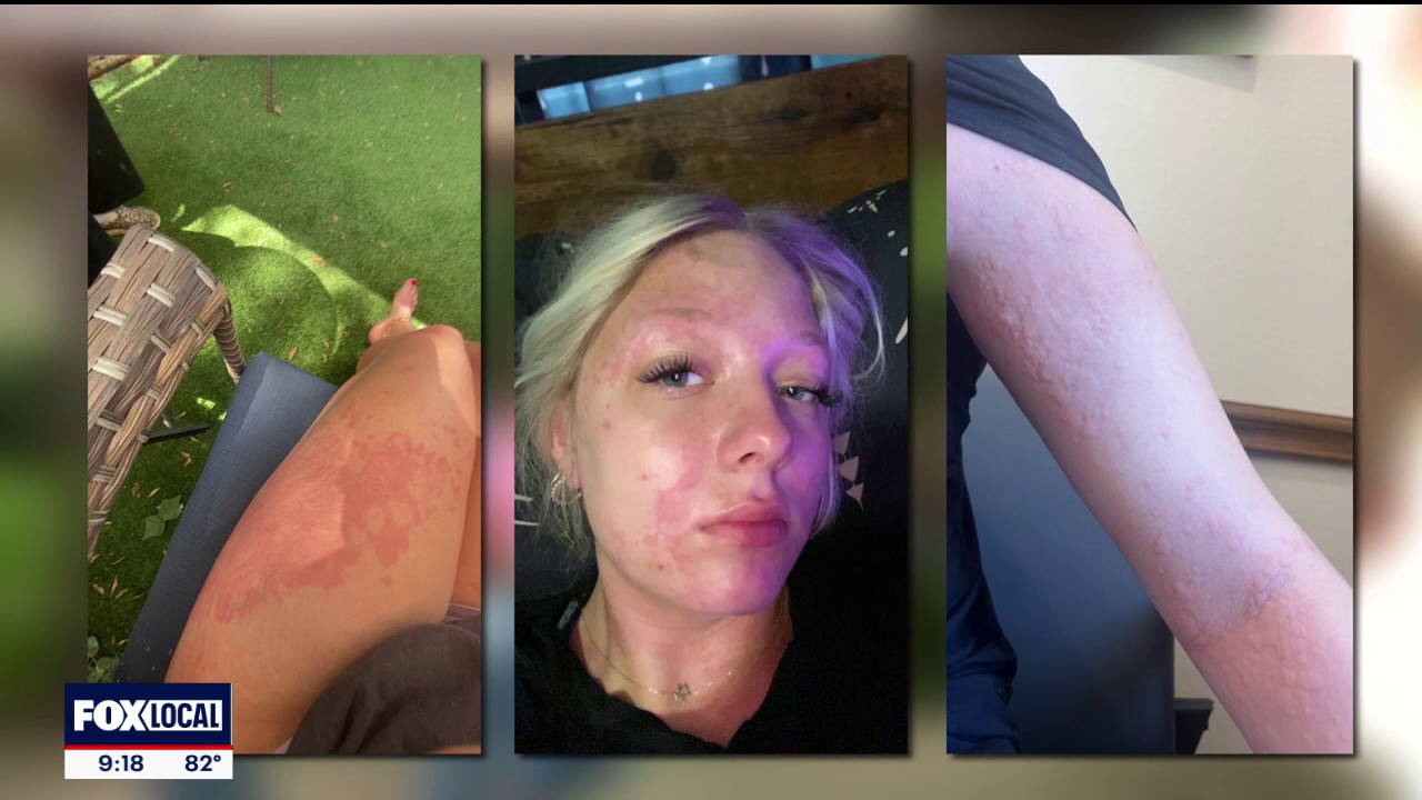 Family says Trinidad water caused chemical burn