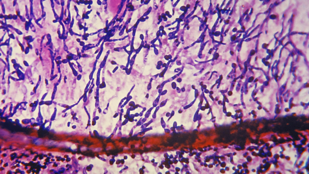 Candida overgrowth decoded for everyday health