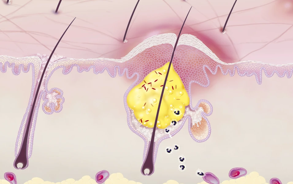 Experts link testosterone therapy to increased adult acne risk