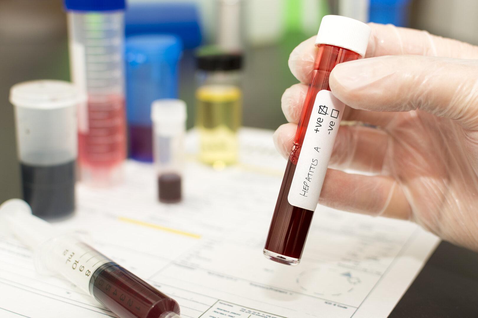 Österreichische Blutspender oft mit Hepatitis E-Antikörpern