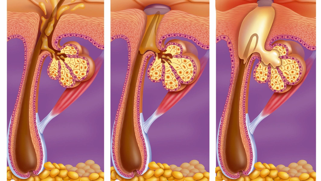 Experts link testosterone therapy to increased adult acne risk