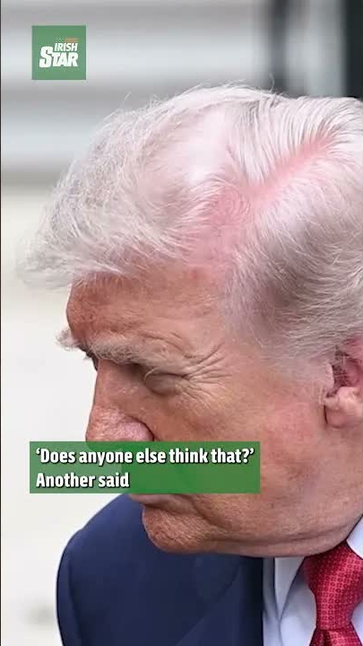 Trump's shock return sparks health concerns amid bruised hand fears