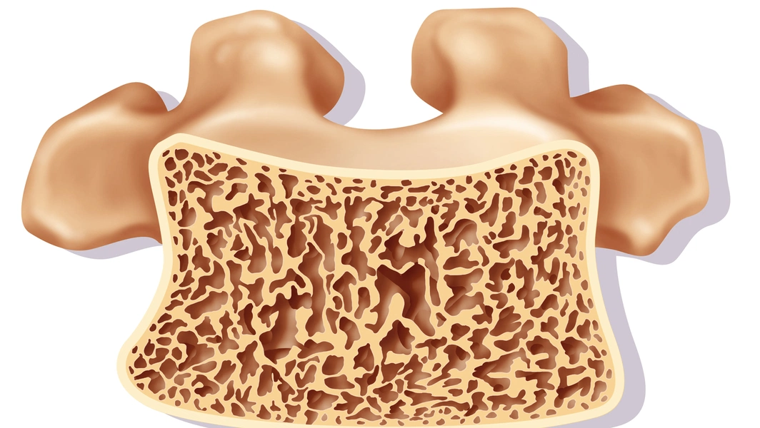Understanding osteoporosis and bone health