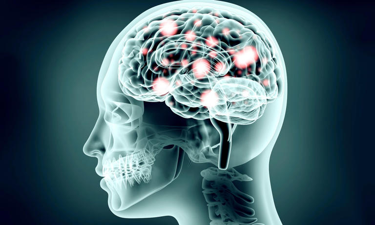 Hope for stroke survivors as researchers improve arm function with ...