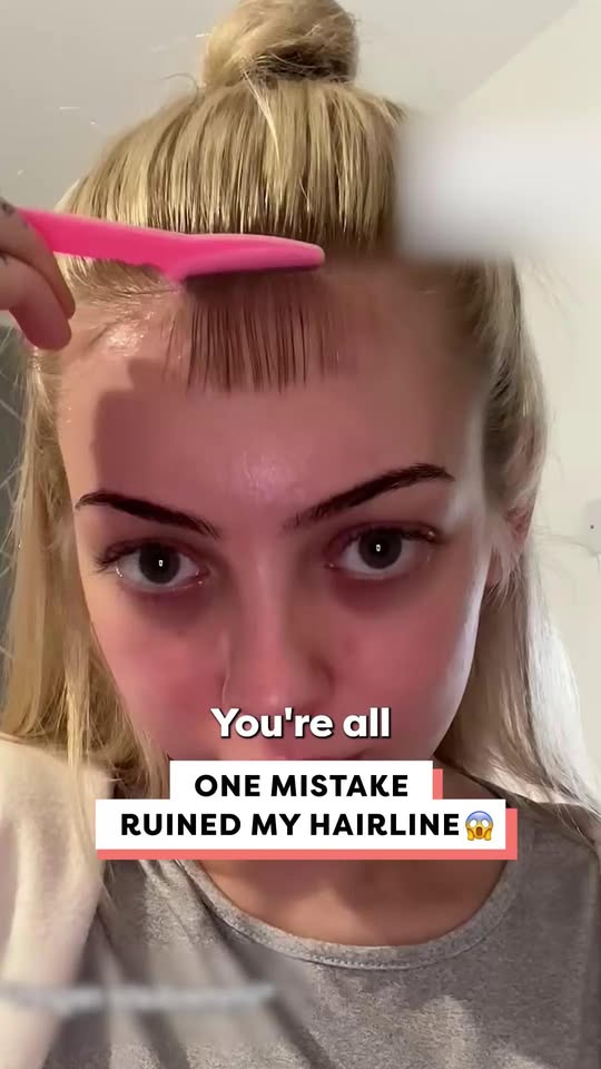 She tried to fix her hairline but made things so much worse