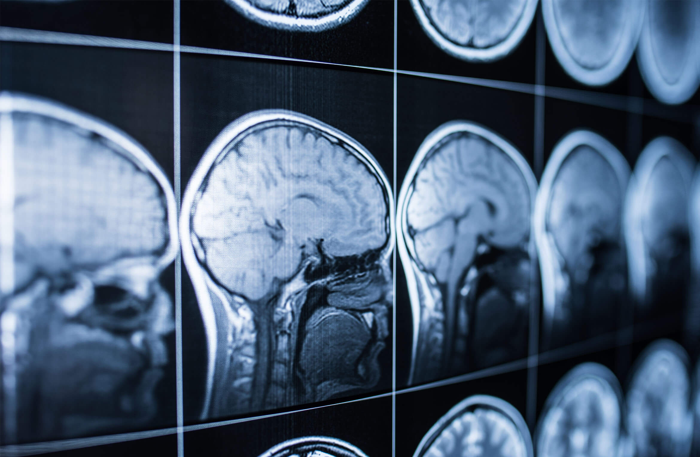 High intake of ultra-processed foods linked to greater dementia risk in ...