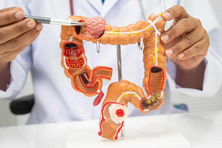 Finally, some good news about early-onset colorectal cancer