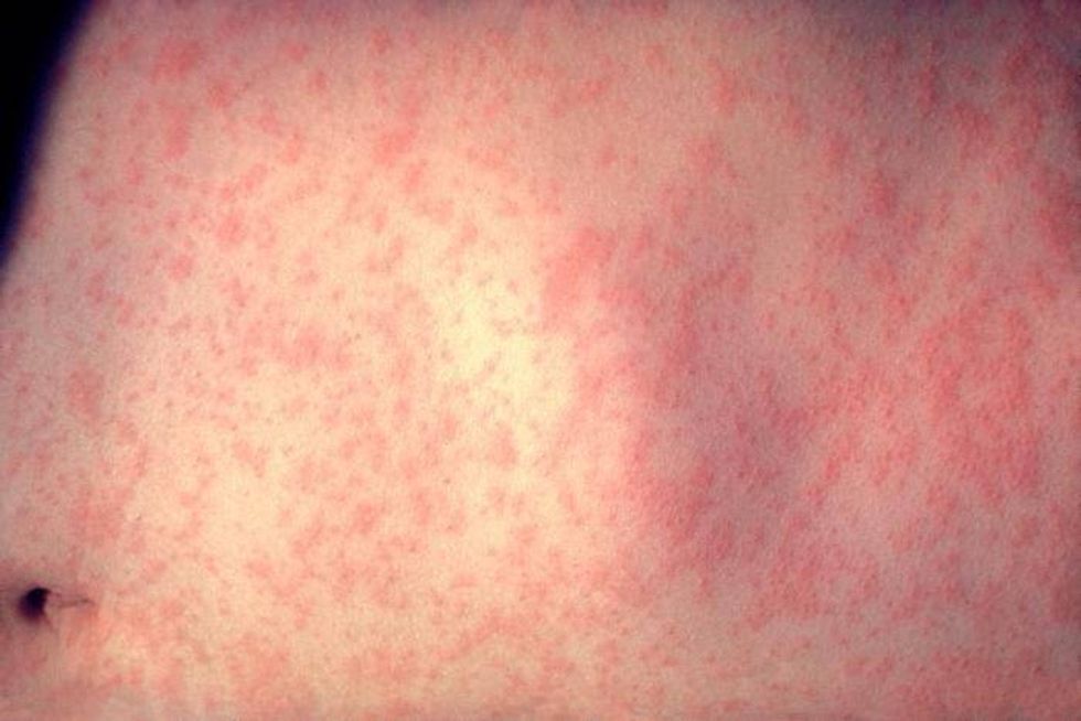 Erie County says measles case confirmed