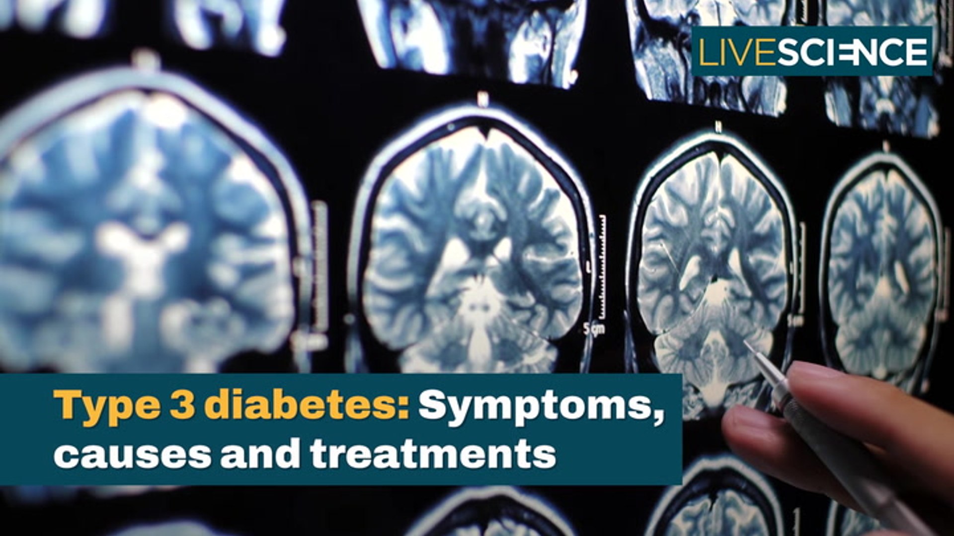What is type 3 diabetes?