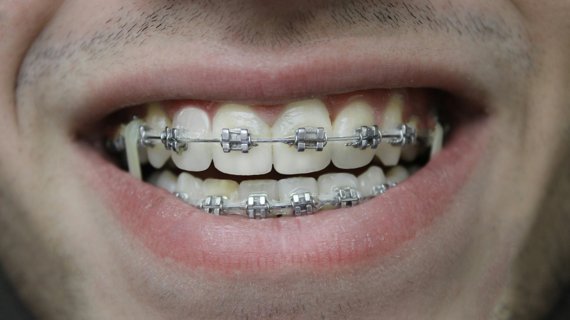 10 reasons to get braces when you're young & 10 why it's best to wait ...