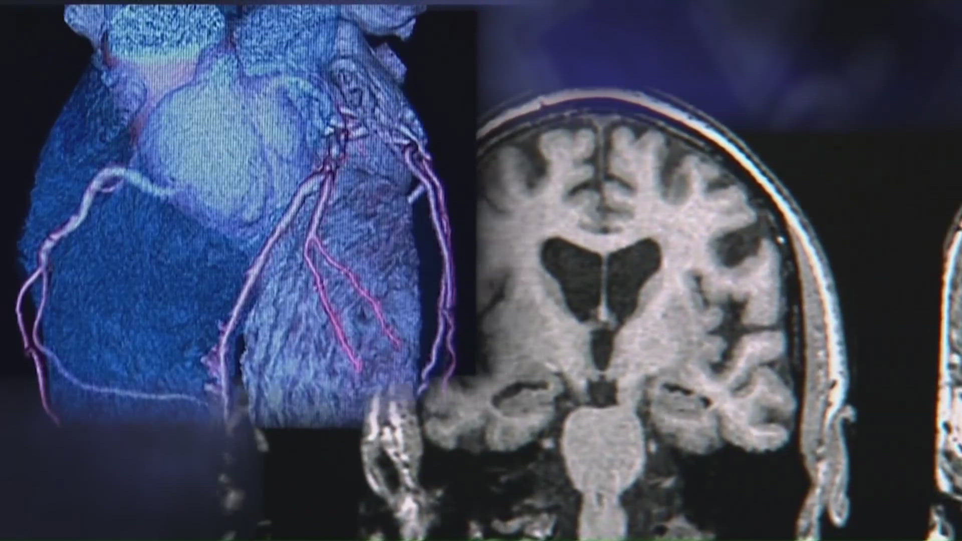 Study connects heart attacks to cognitive decline