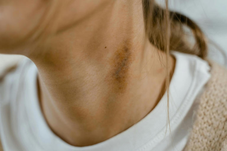 Mysterious blue bruises without injury? Here’s what your body may be ...