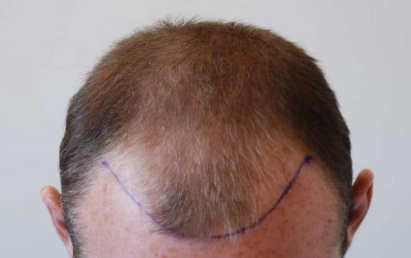 Clinic behind Rooney’s hair transplant still get five requests a day ...