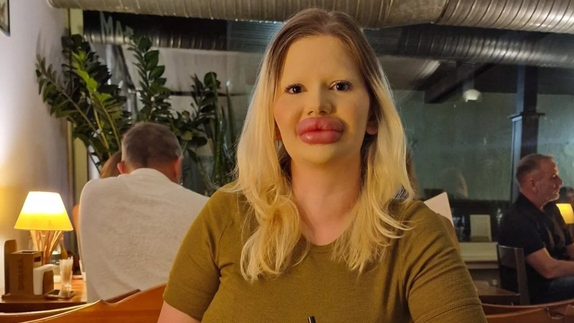 I’ve paid £20,000 and had 32 injections to have the world’s biggest lips
