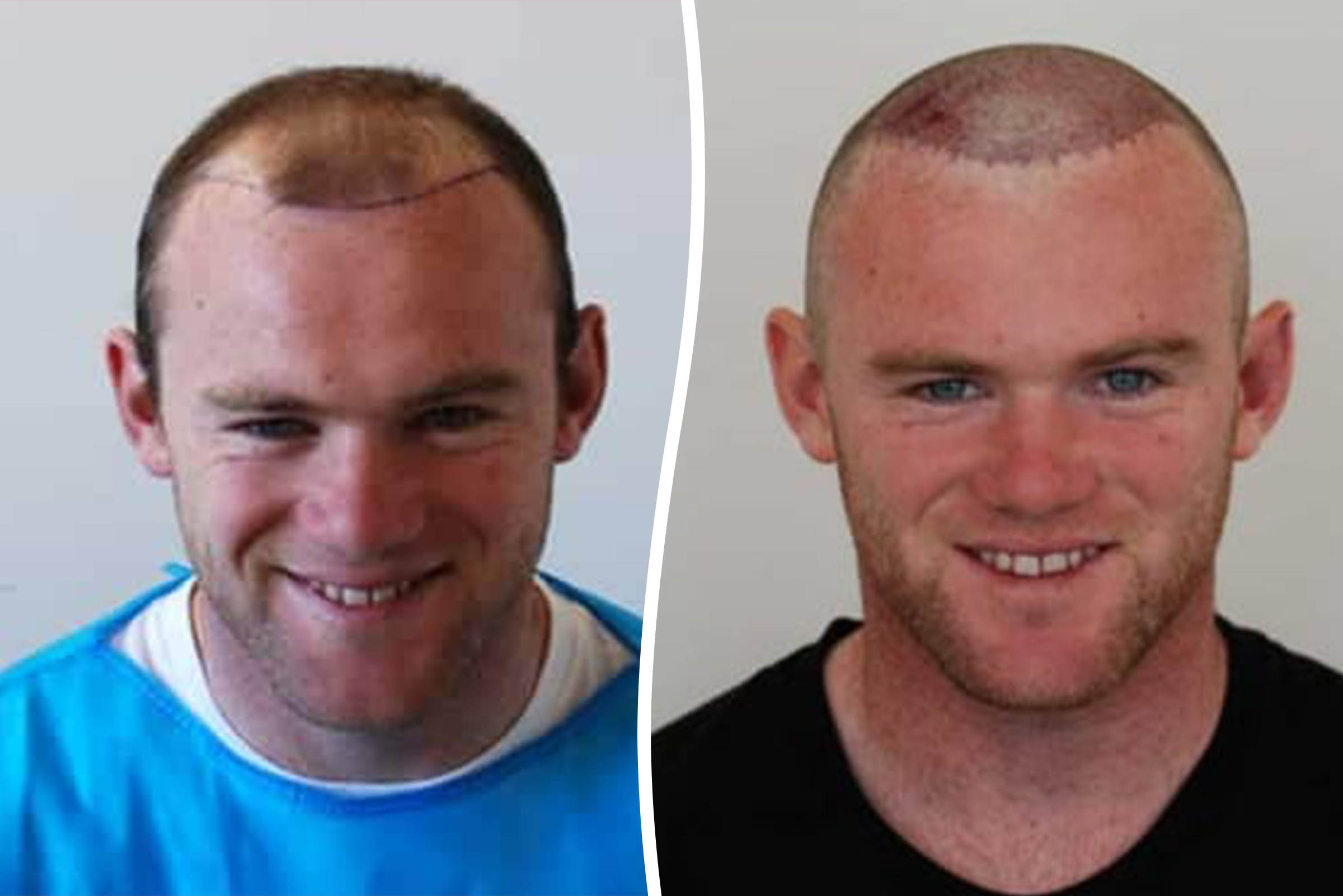 Clinic behind Rooney’s hair transplant still get five requests a day ...