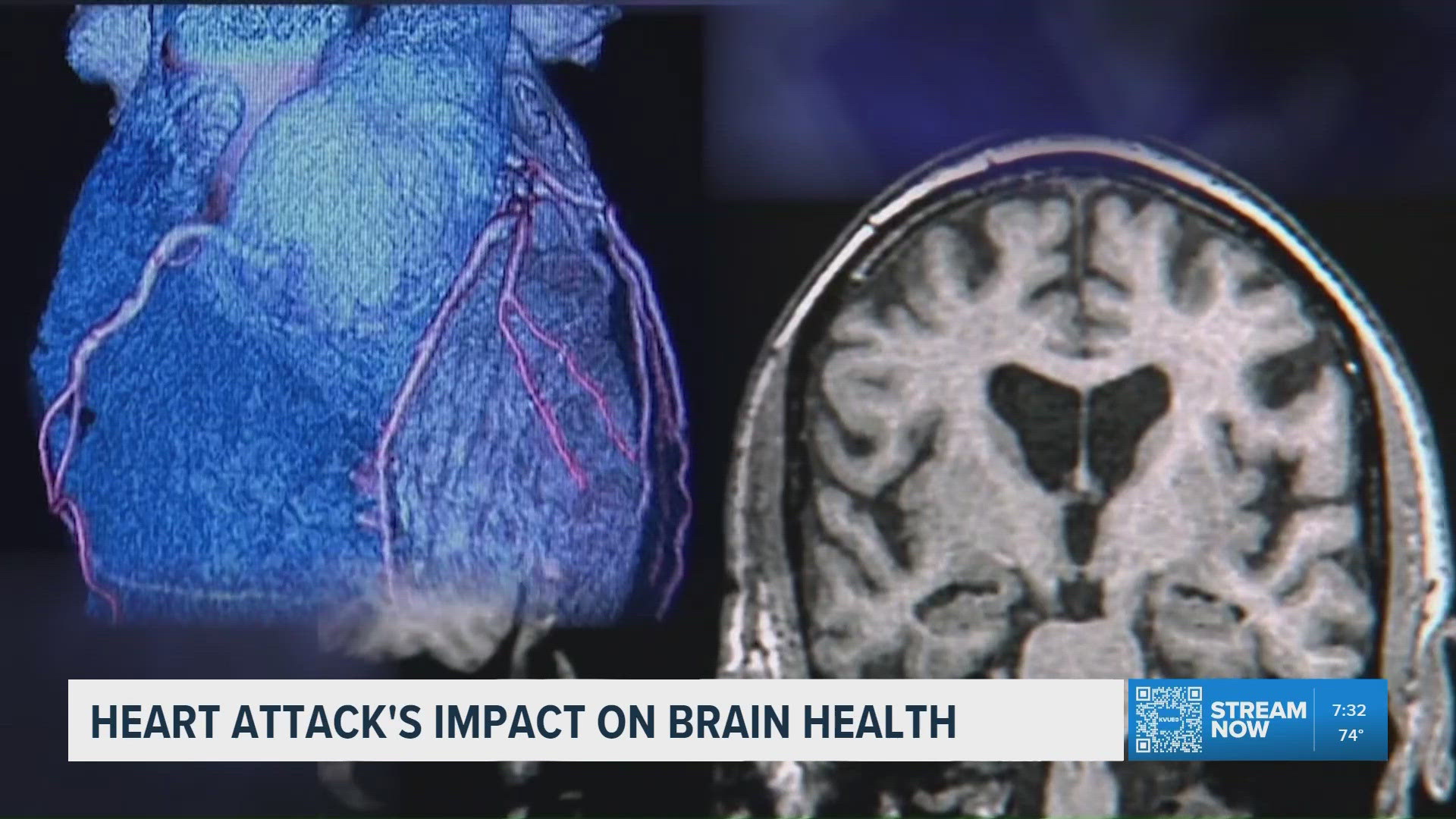 How heart attack survivors can work to protect their brain
