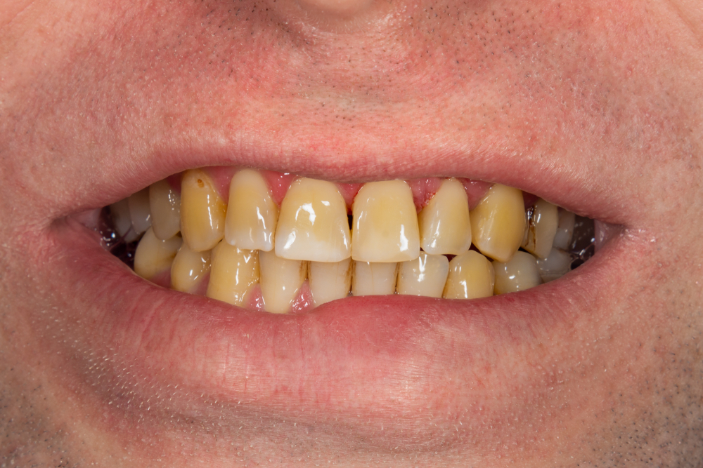These foods and drinks can make your teeth yellow
