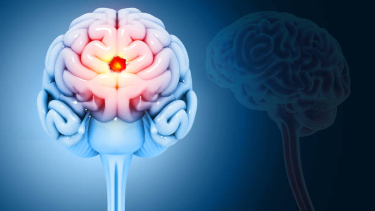 The first signs of a brain tumour are often mistaken for stress ...