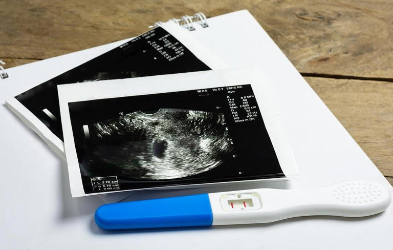 Wearable ultrasound patch provides continuous fetal monitoring