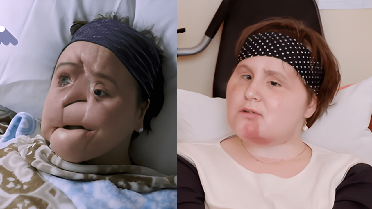 Doctor reacts to youngest face transplant case