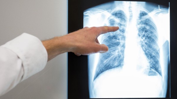 Lungenfibrose bei Mette-Marit: Das sind Ursachen und Symptome der Krankheit