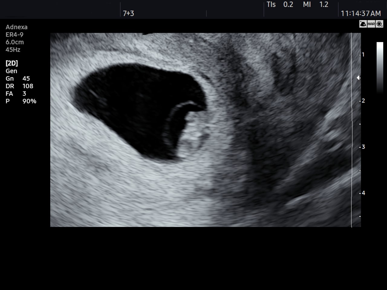 Scientist edits human embryo genes, but questions remain