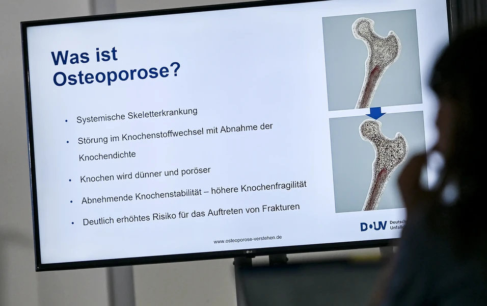 Experts outline early signs and evolving care for osteoporosis