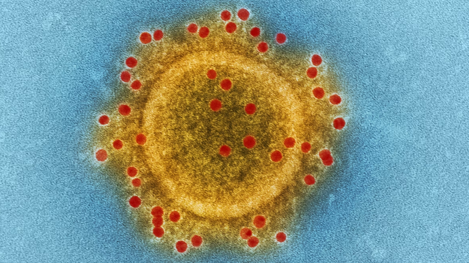 CDC reports 1,893 measles cases across 40 US jurisdictions in 2026