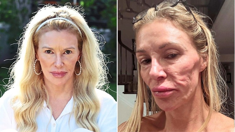 Brandi Glanville says her face is sinking in again amid ongoing health ...