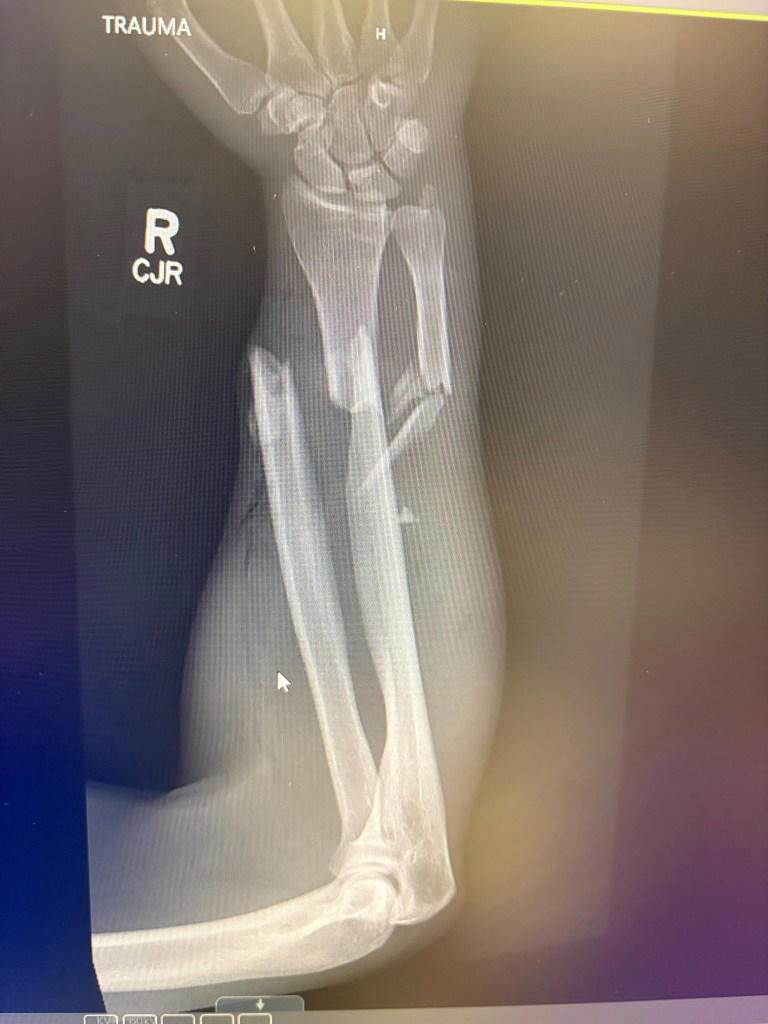 Hiker details horrifying grizzly attack in Glacier National Park