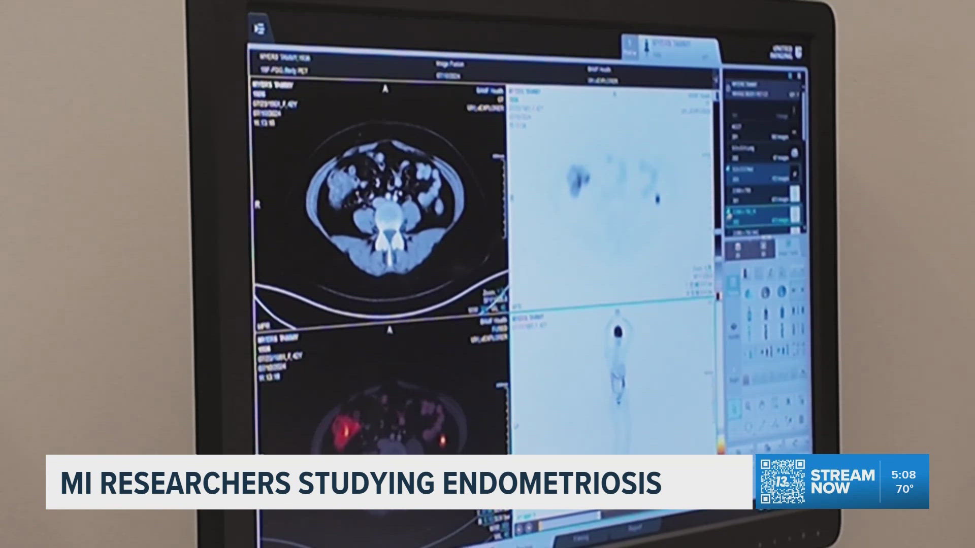 West Michigan researchers seek a less invasive way to diagnose ...