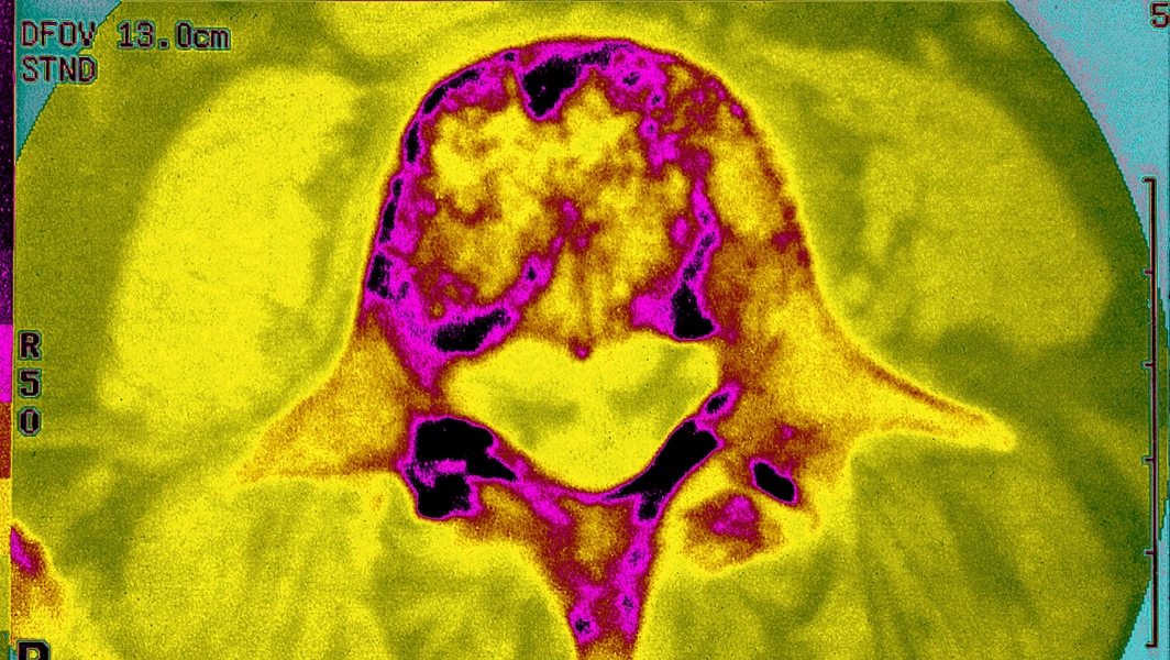 Experts outline early signs and evolving care for osteoporosis