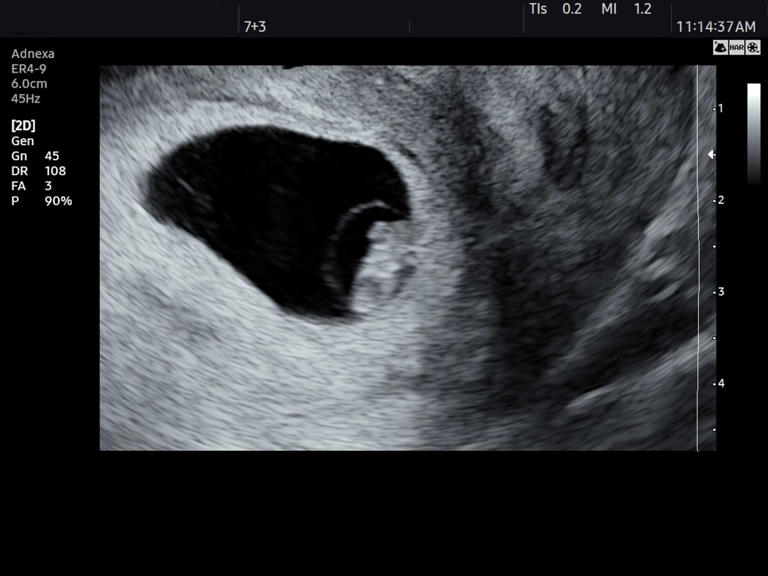 Scientist edits human embryo genes, but questions remain