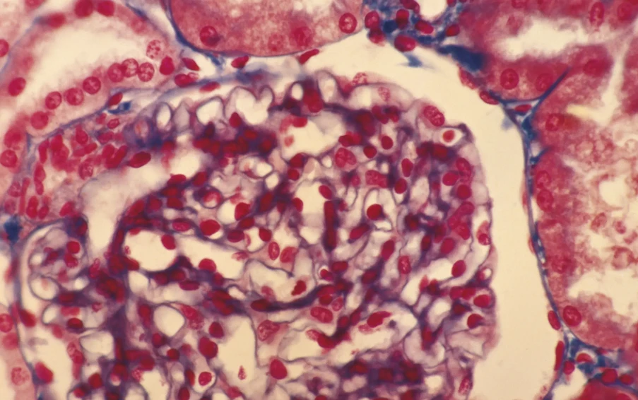Study confirms CKD diagnostic threshold with measured GFR data