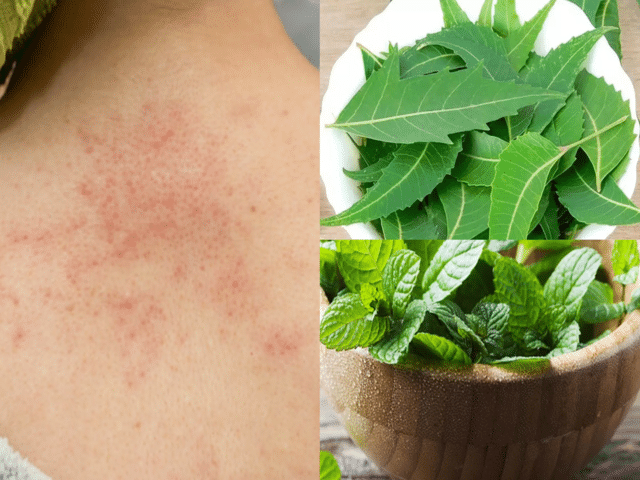 Home remedies for heat rash: Troubled by heat rash in the summer? This ...