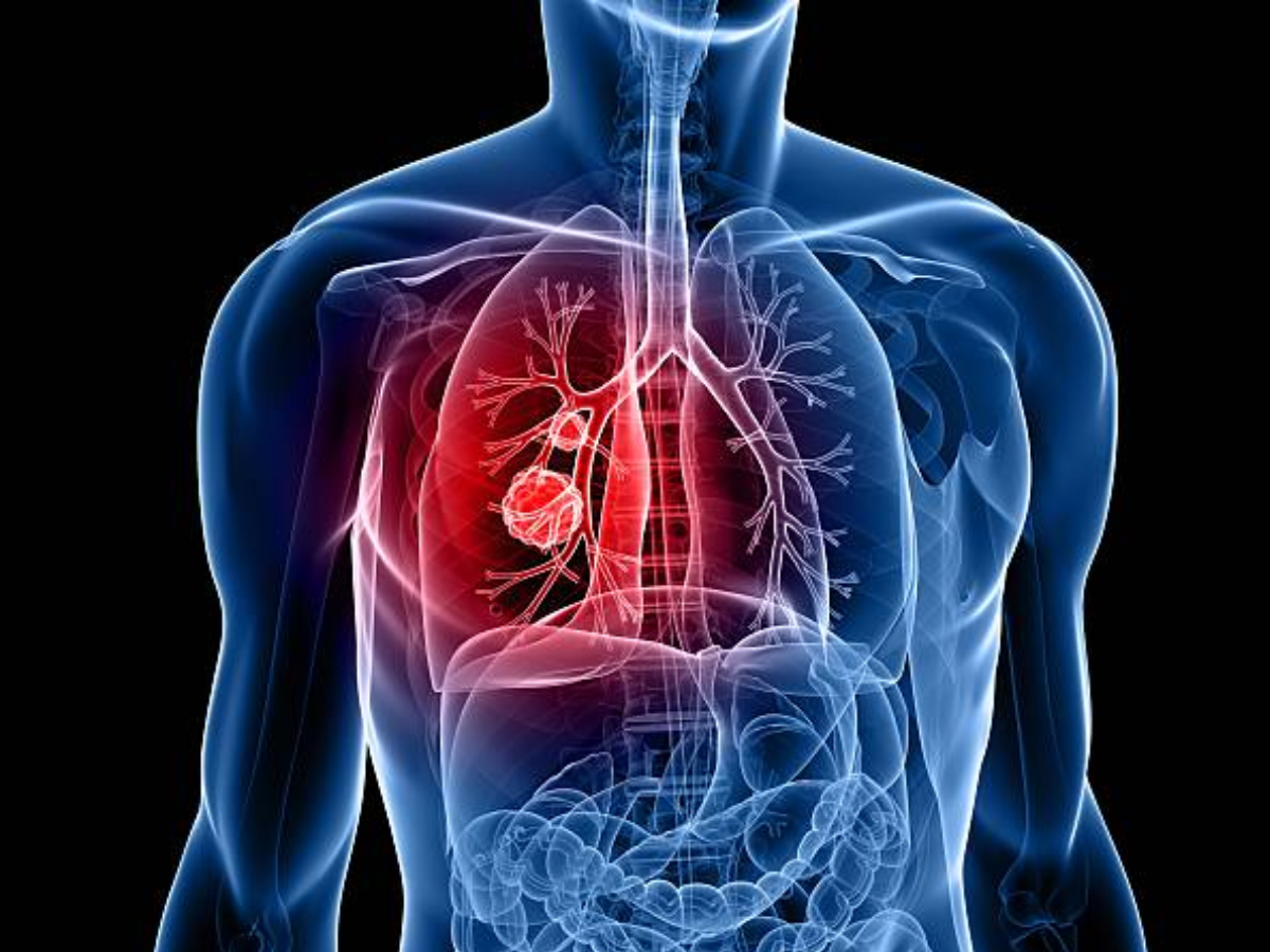 This blood test may reveal lung cancer risk long before symptoms