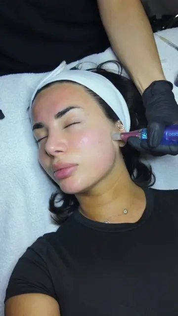 I tried microneedling again and my skin is glowing