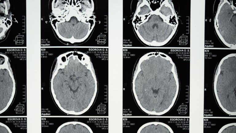 Your brain’s decision-making cortex finishes wiring only in your mid ...