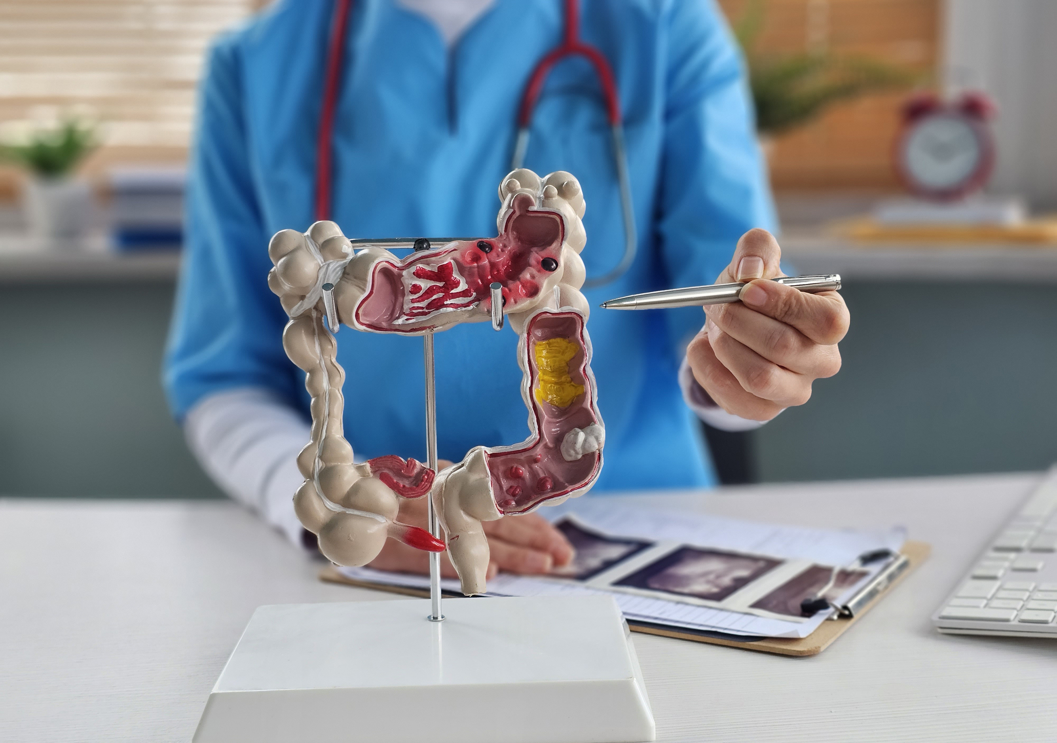 Mayo Clinic Q&A: What do you know about colon cancer?