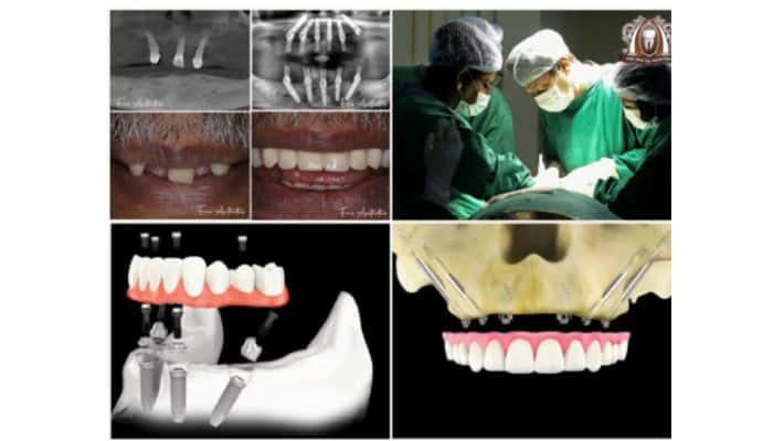 Advancements in dental implants in India is transforming full-mouth ...