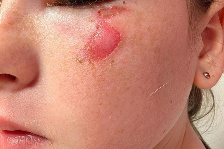 Scots schoolgirl nearly loses eye after toy bought from Tesco explodes ...