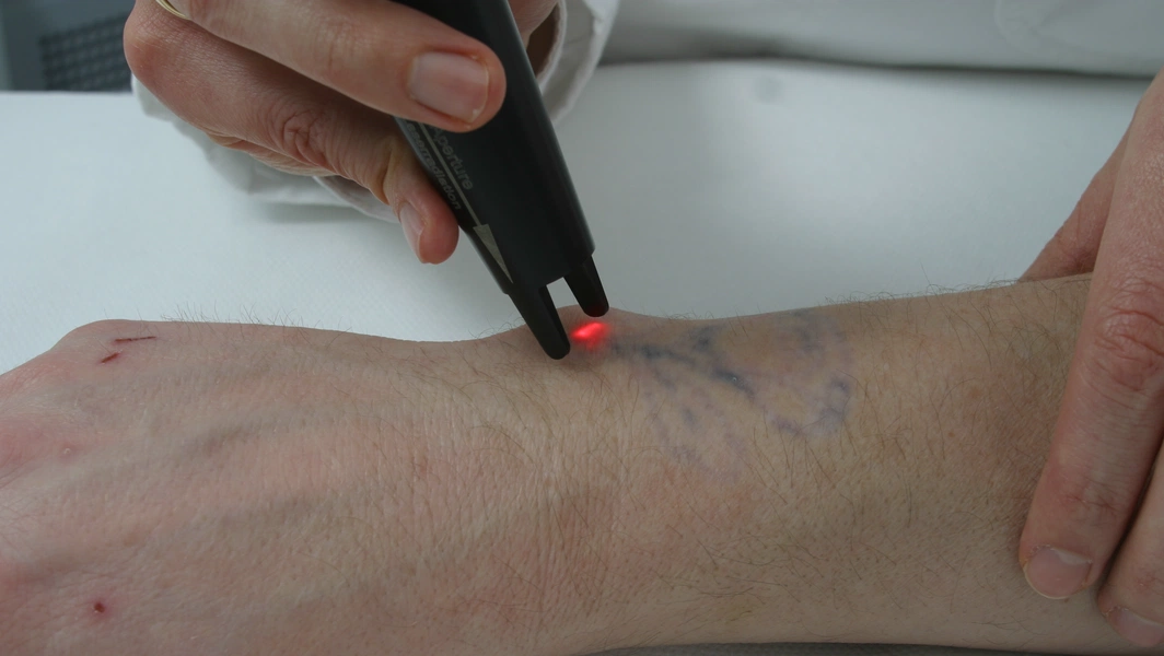 Laser and light therapy decoded for every skin tone