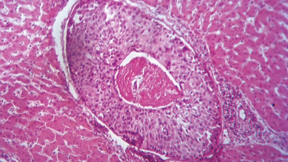 GLP-1 drugs linked to lower cancer spread risk