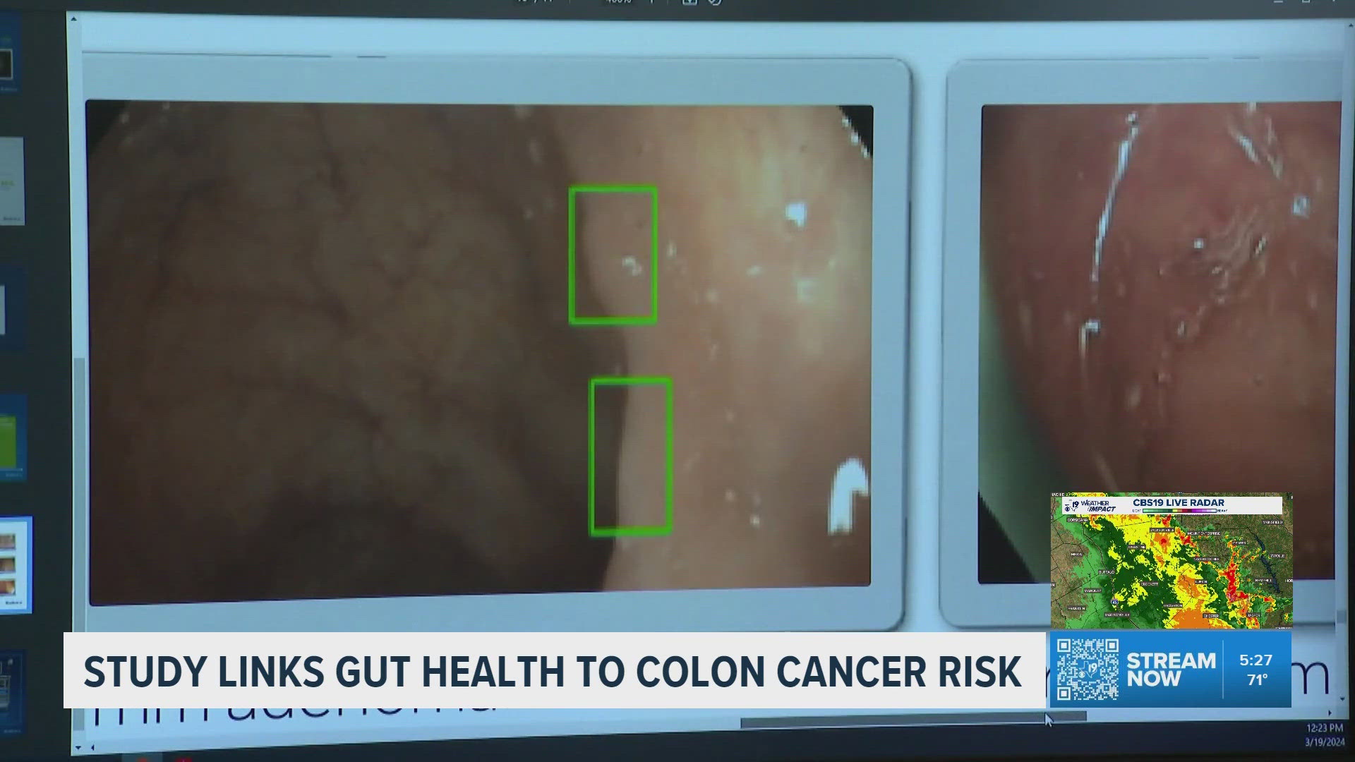 Study finds diet and lifestyle may shape colon cancer risk through gut ...